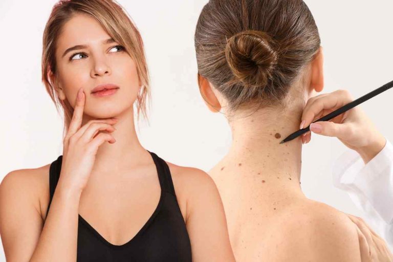 Come riconoscere un neo sospetto? Attenzione a questi dettagli - Ma Che ...